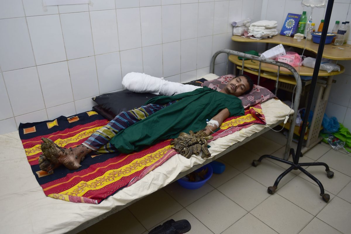 Bangladesh 'Tree Man' Undergoes First Operation in Dhaka Medical ...