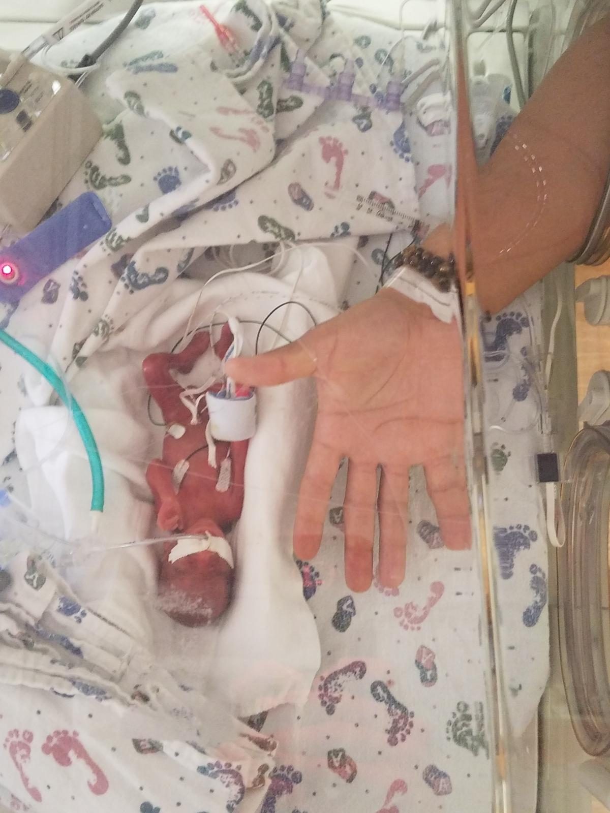 Miracle Baby Born At 23 Weeks Weighing 13 Ounces In Iowa miracle-baby-born-at-23-weeks-weighing-13-ounces-in-iowa