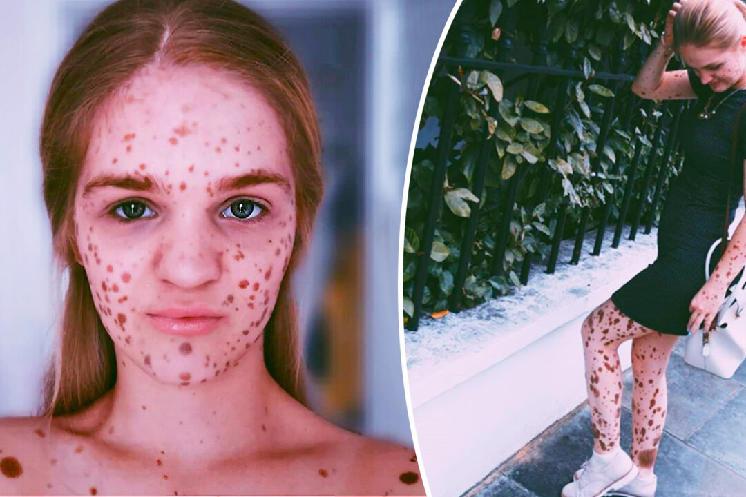 Young Woman Was Bullied for Her Birthmarks–Now She Is a Model and ...
