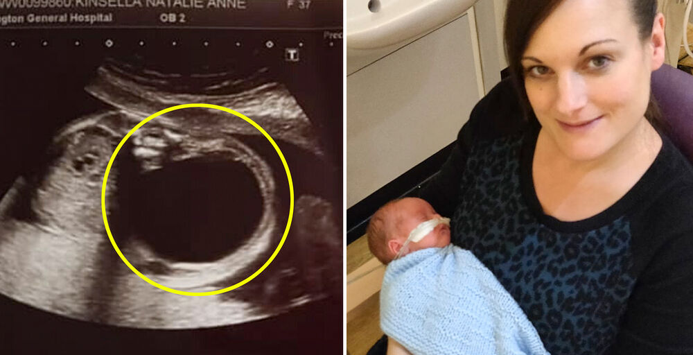 ‘Petrified’ Mom of Four Endures Two Pioneering Surgeries to Save Unborn ...