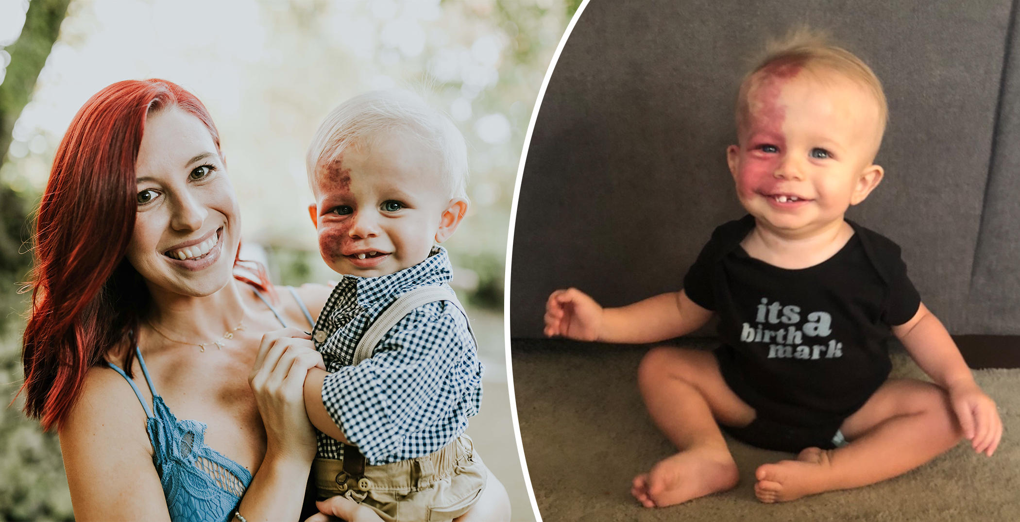 Adorable Baby Born With a Large Facial Birthmark Deemed ‘Perfect’ by ...