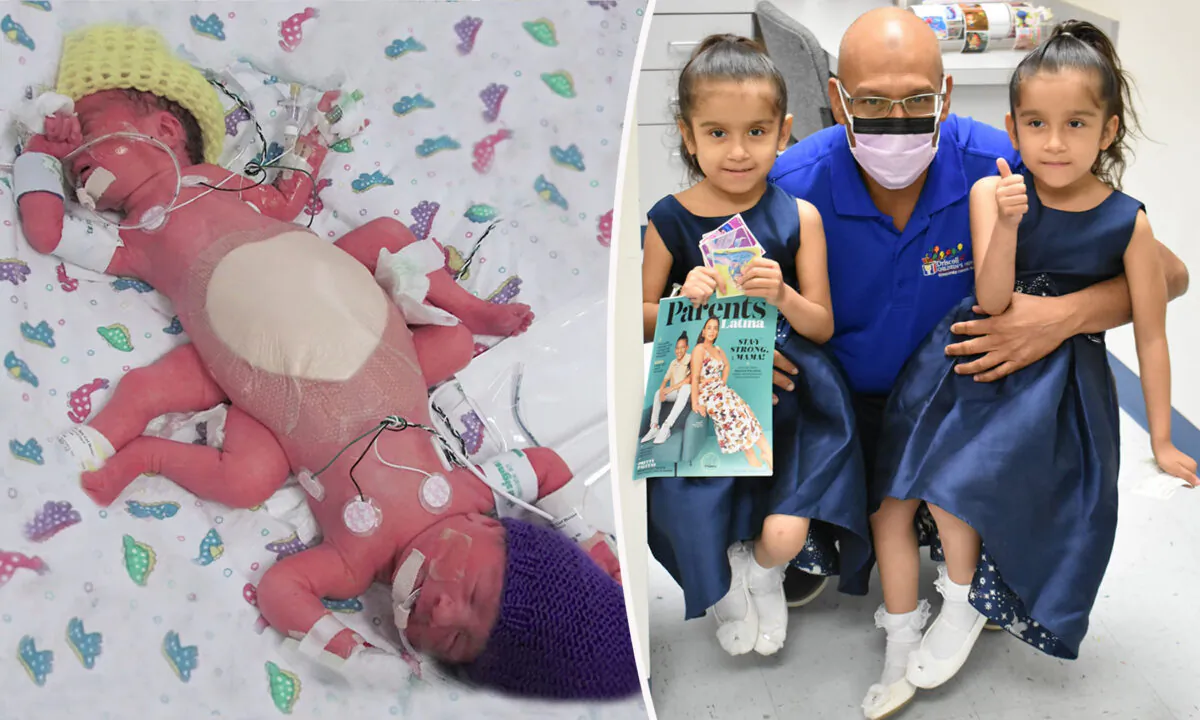Formerly Conjoined Twins Thriving 5 Years After Separation Reunite With ...