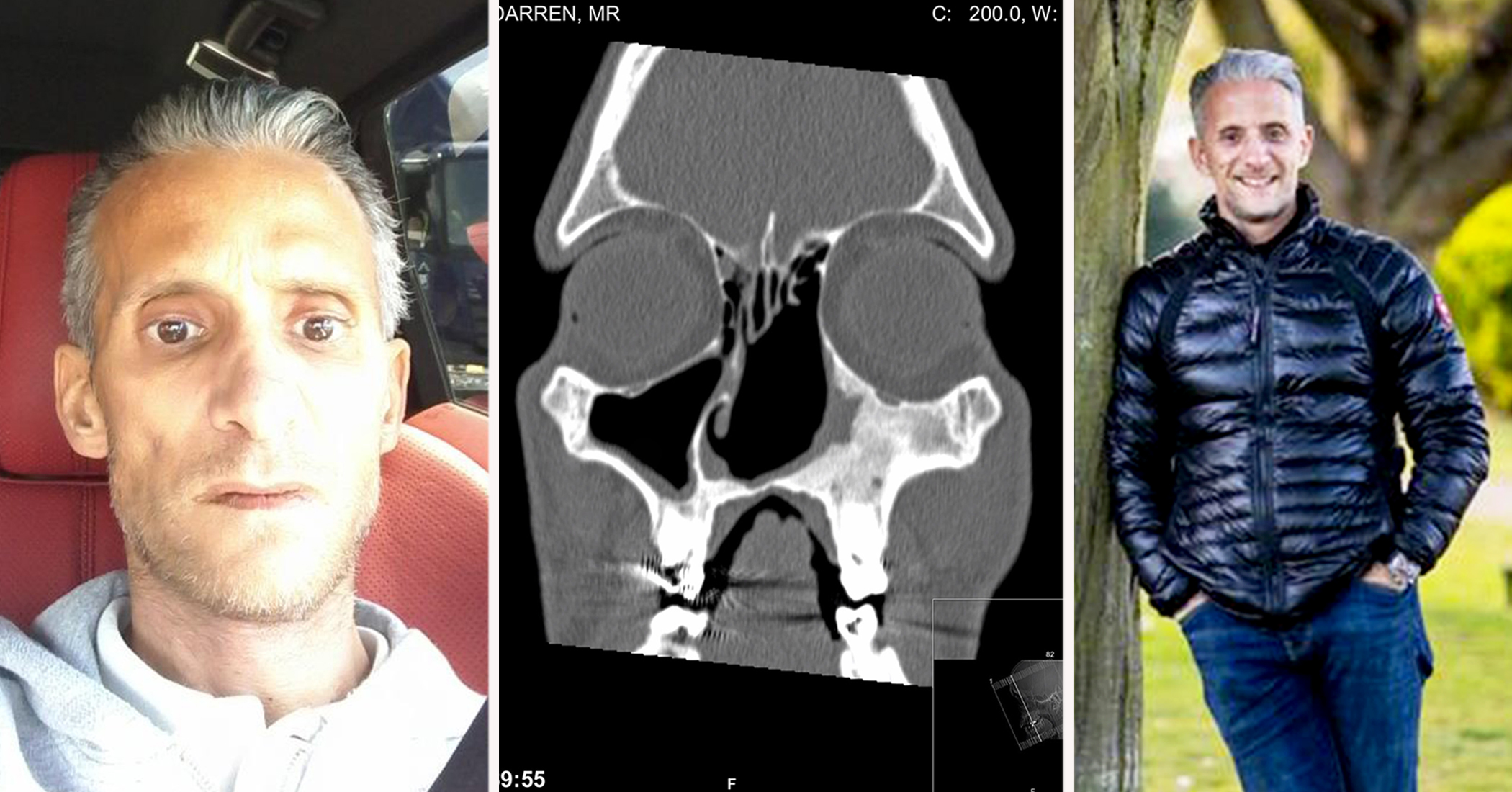 Man’s Cocaine Abuse Destroyed His Septum and His Marriage, 4 Years ...