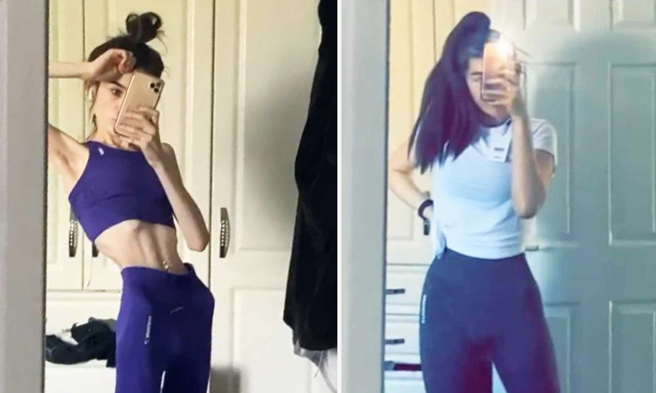 Bulimia Pictures Before And After Rehabilitation Of Bulimia With