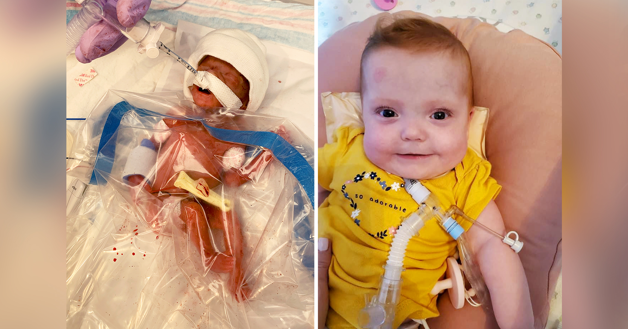 1lb Premature Baby Born At 22 Weeks And Saved By Sandwich Bag Thrives 