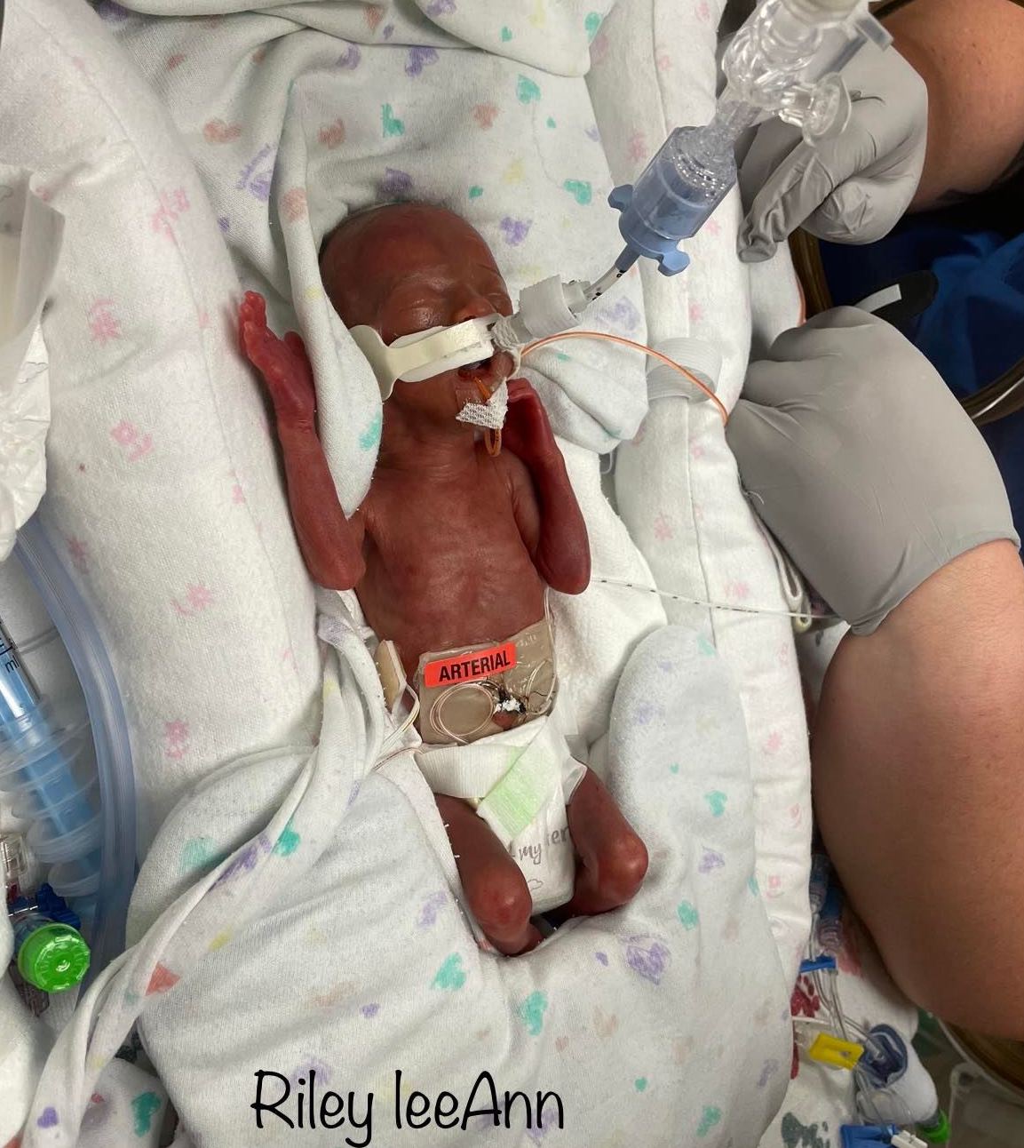 Mom Born With Double Uterus Delivers Hospital’s Youngest Surviving Baby ...
