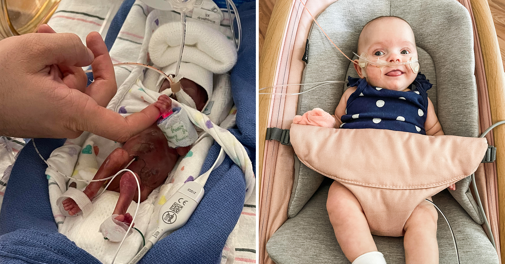 Baby Born at 11 Ounces Smallest to Survive in Hospital’s NICU, Finally ...