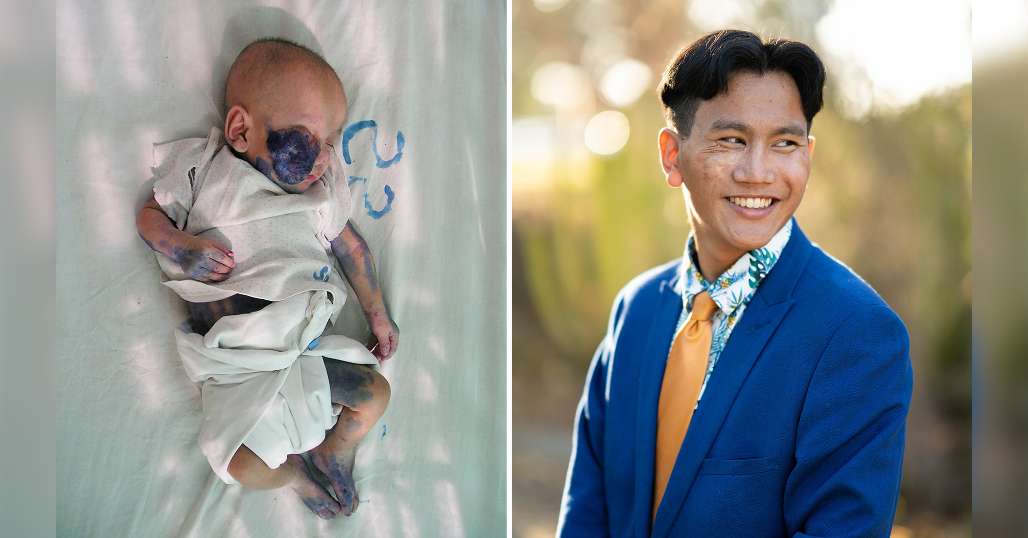 Vietnamese Baby With Facial Tumor Gets Adopted in the US, Reunites With ...