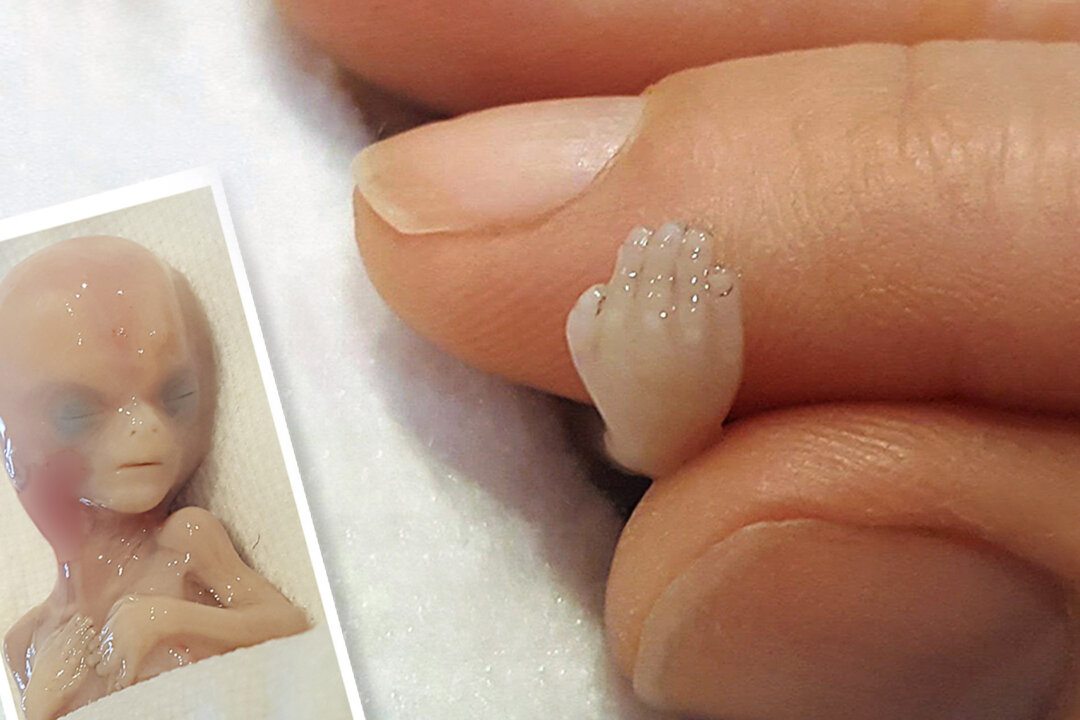 Photos of ‘Perfectly Formed’ 14-Week Miscarried Baby Are Saving Lives ...