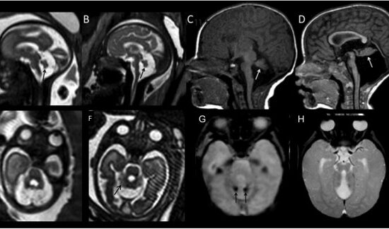 Dandy-Walker Syndrome | The Epoch Times
