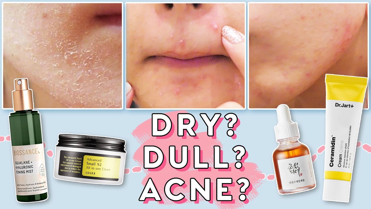 Stress Acne: 4 Ingredients for Calming Stressed Out, Acne-Prone ...