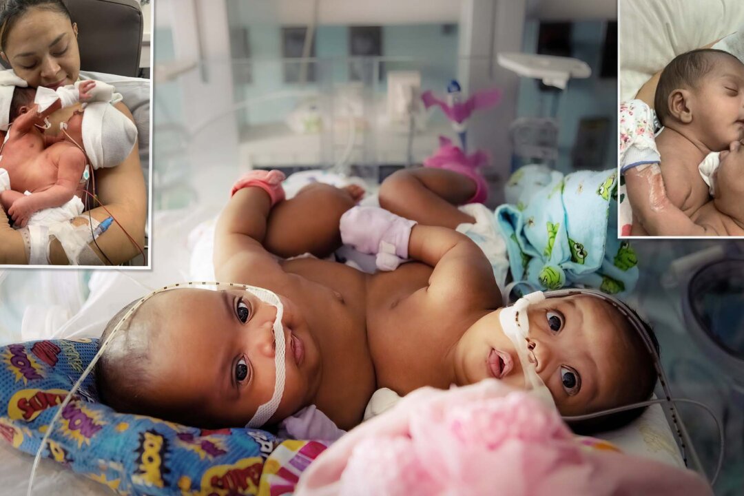 Conjoined Twins Undergo 11-Hour Separation by Team of 27 Medical Staff ...