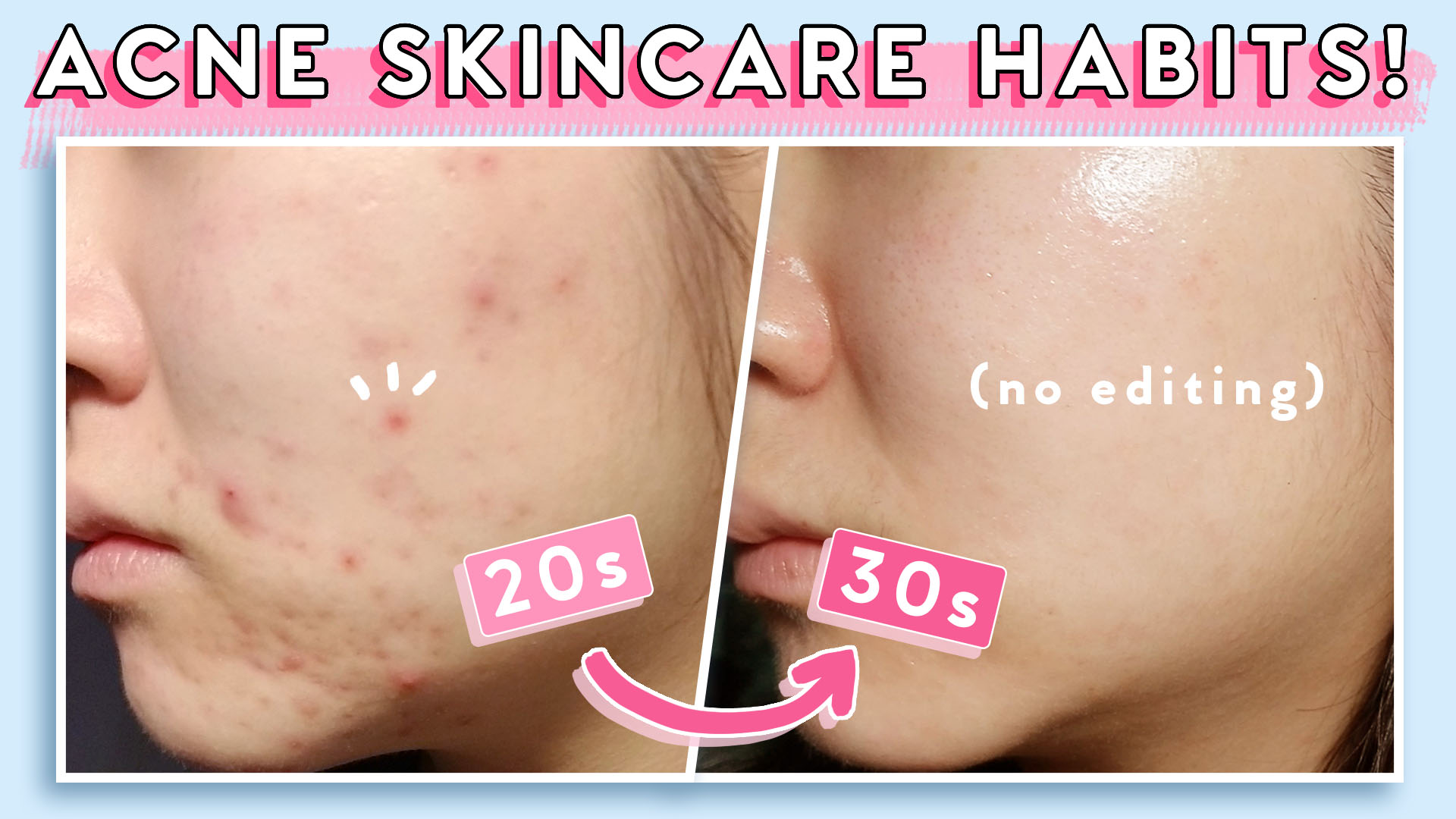 5 Skincare Tips for Acne in Your Teens, 20s, & 30s: Oily/Combination ...