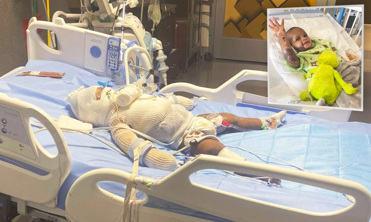 Baby Severely Burned in Candle Explosion Defies the Odds, Proves ...