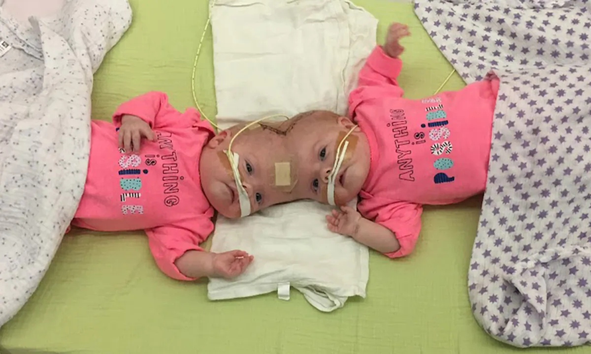‘One-in-2.5 Million’ Conjoined Twin Girls Who Survived Separation ...