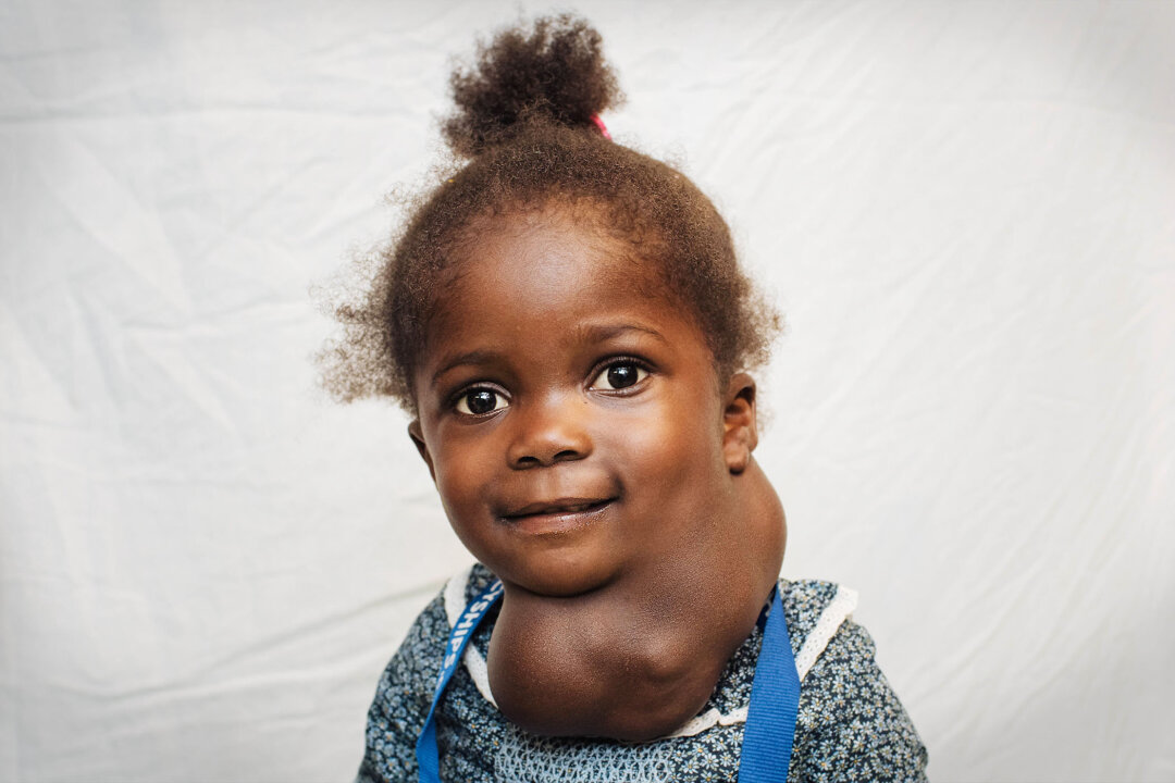 Toddler Was Born With Face-Sized Mass Growing on Her Neck Suffocating ...