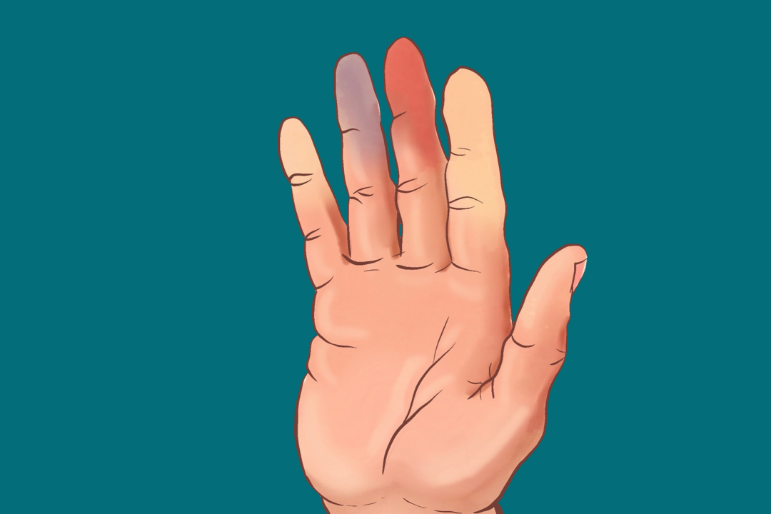 5 Exercises to Counter the Bizarre Symptoms of Raynaud’s Phenomenon ...