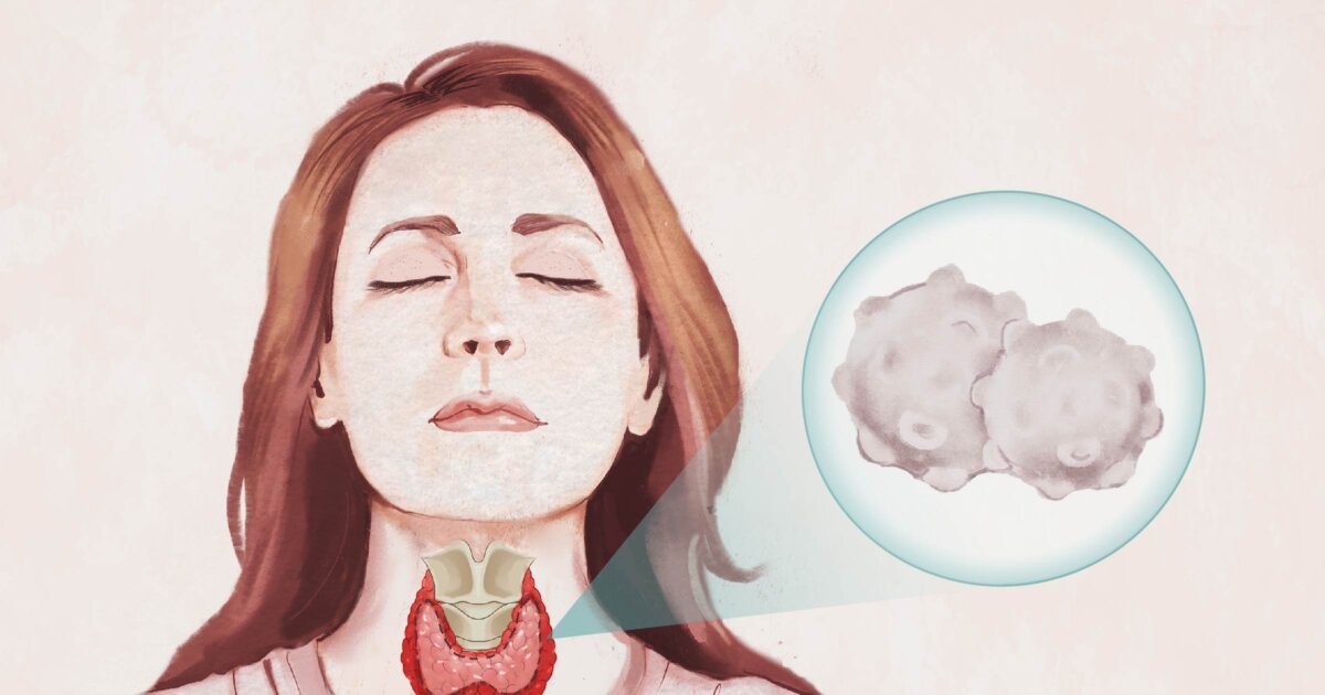 Hashimoto’s Thyroiditis: Symptoms, Causes, Treatments, and Natural ...