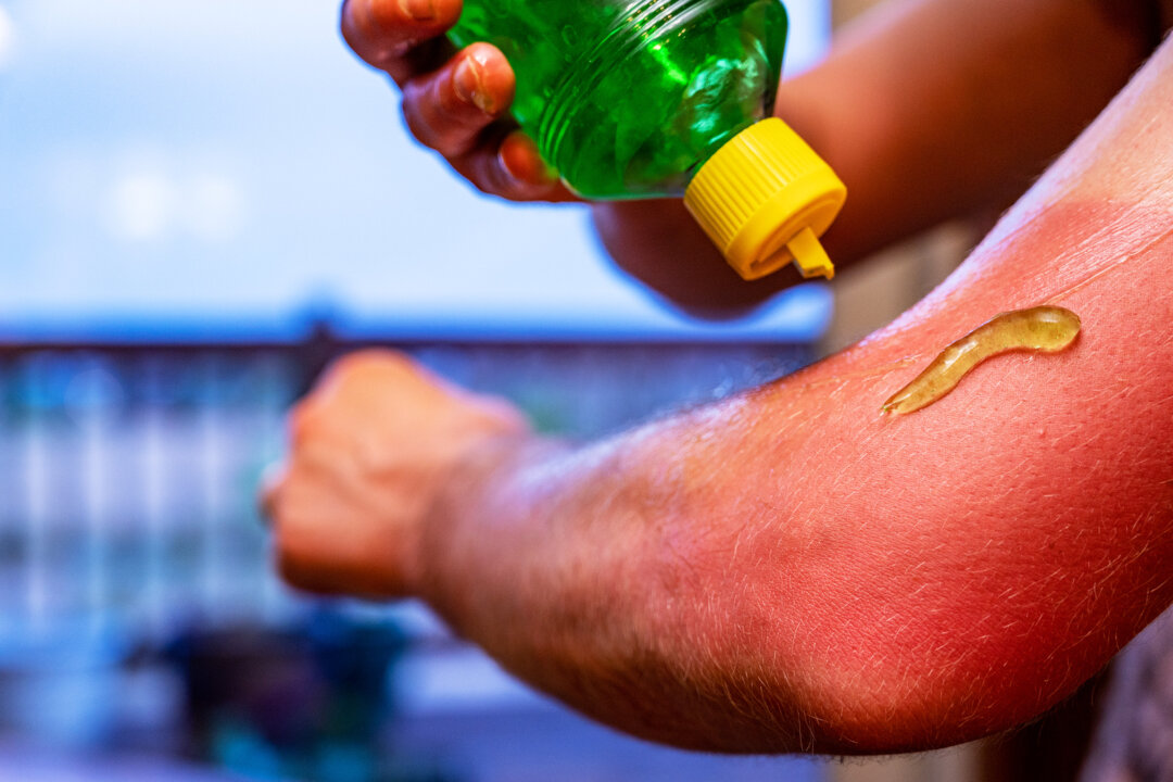 Australian National Review - Sunburn’s Real Culprit: It’s Not Just DNA