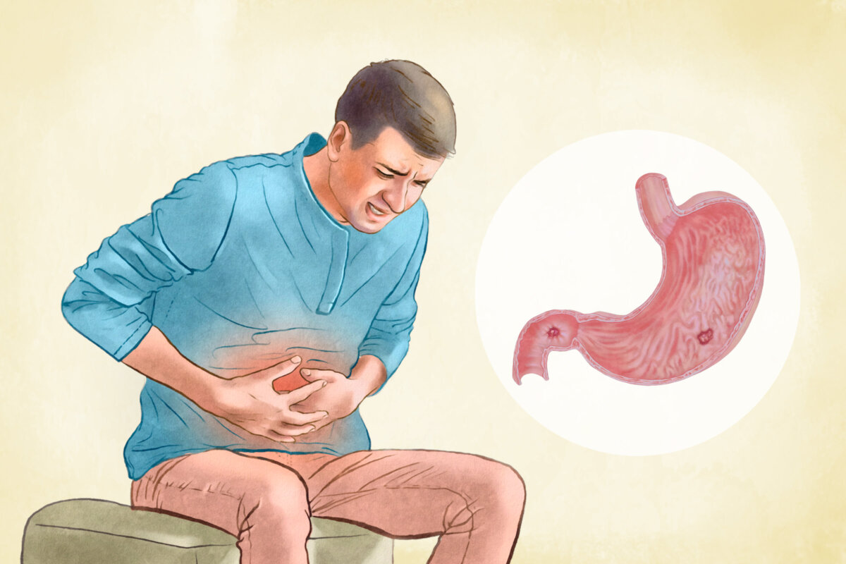 Stomach Ulcers: Symptoms, Causes, Treatments, and Natural Approaches