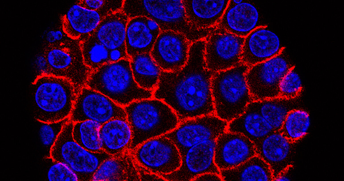 Drug Reduces Risk of Prostate Cancer Spread and Death in Late-Stage Study